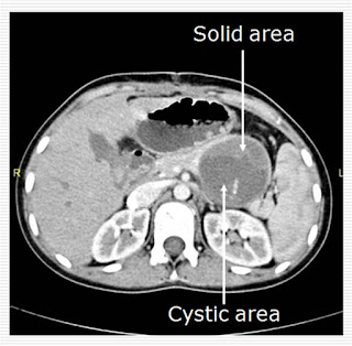 Treatment For Pancreatic Cyst-Solid Pseudopapillary Tumor...