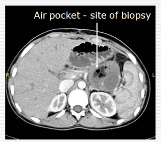 Treatment For Pancreatic Cyst-Solid Pseudopapillary Tumor...
