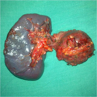 Treatment For Pancreatic Cyst-Solid Pseudopapillary Tumor...