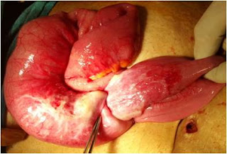 1.Adult Intussusception - GI Cancer India...